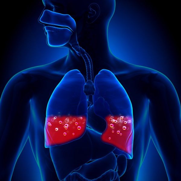 Pulmonary Edema What Is It Blog Orthopaedic Specialists Pulmonary Edema What Is It Blog Orthopaedic Specialists
