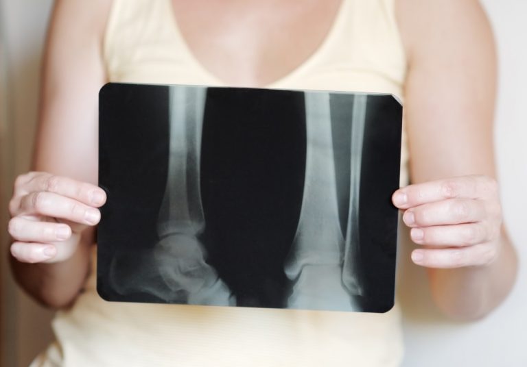Bone Marrow Edema: Understanding What It Is - Orthopaedic Specialists