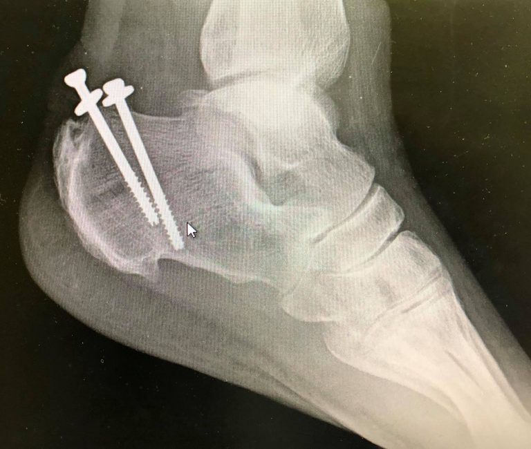 When a Screw Comes Loose - The Orthopaedic Specialists of Louisville