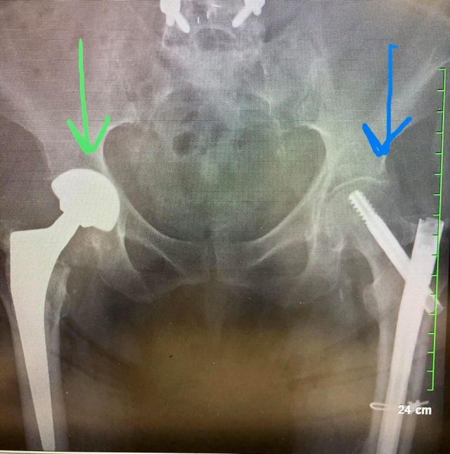 Broken Hip? - The Orthopaedic Specialists in Louisville, Kentucky