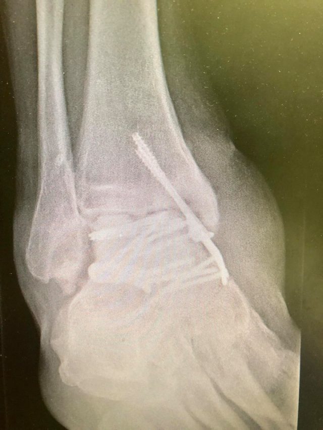 Shattered Talus - The Orthopaedic Specialists of Louisville, Kentucky