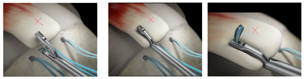 Patient Education: Rotator Cuff Surgery - Louisville Bones