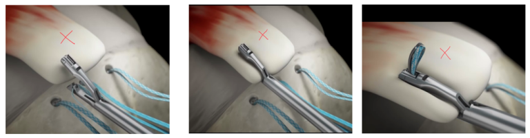 Patient Education: Rotator Cuff Surgery - Louisville Bones