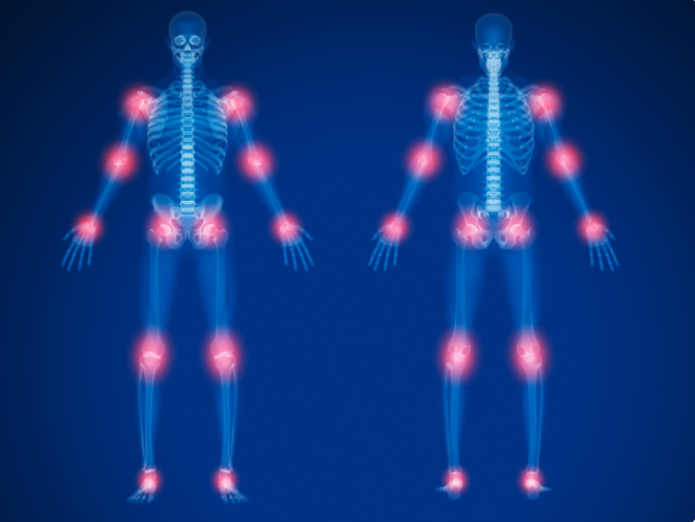 Osteoarthrosis, Osteoarthritis | Orthopedic Specialists Louisville KY